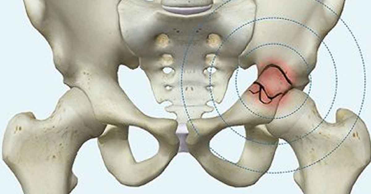 Fraturas do Quadril: Riscos e recuperação